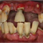 Photos du cancer de la bouche - A quoi ressemblent les plaies du cancer ...