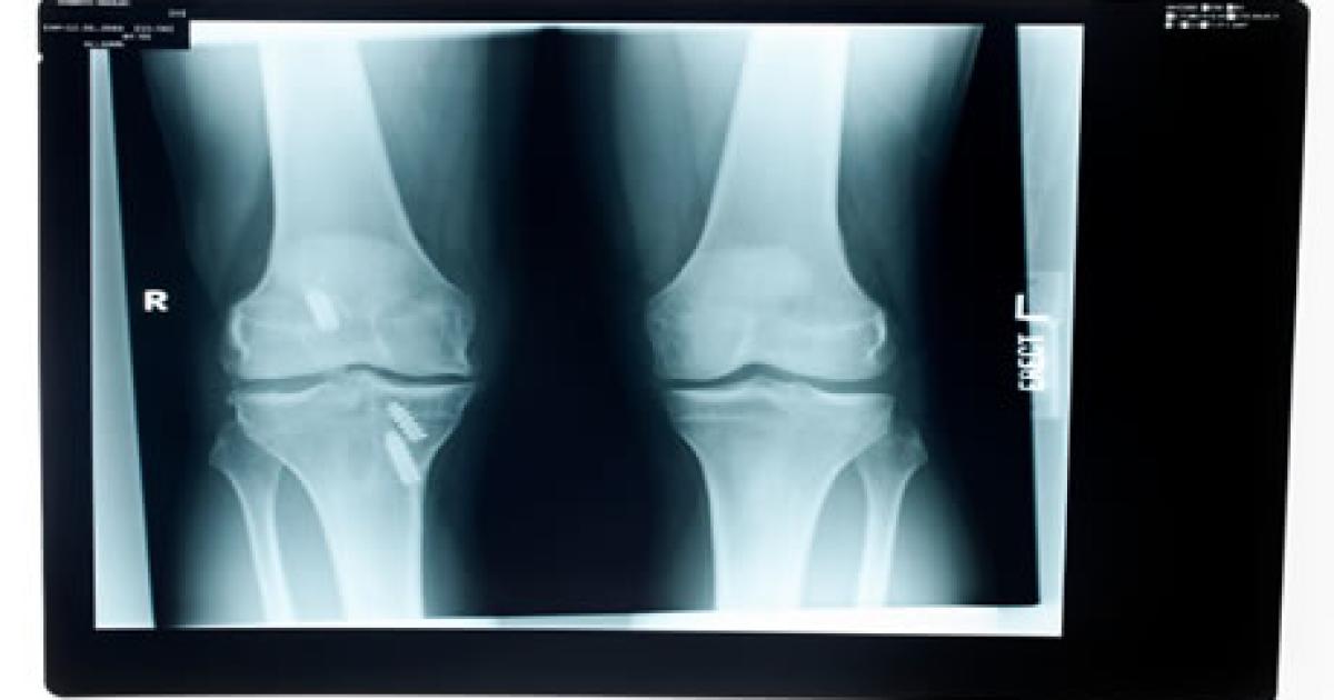 Chirurgie du LCA | Reconstruction du LCA Détails de la procédure ...