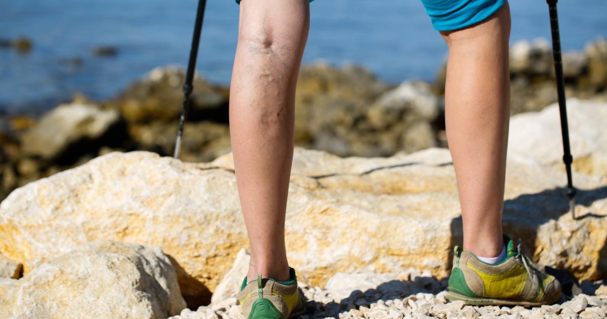 Enflure derrière le genou - Symptômes, causes, traitements