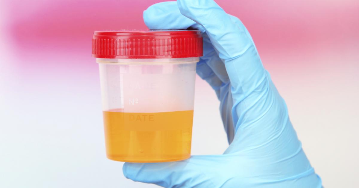 Urine brune - Symptômes, causes, traitements