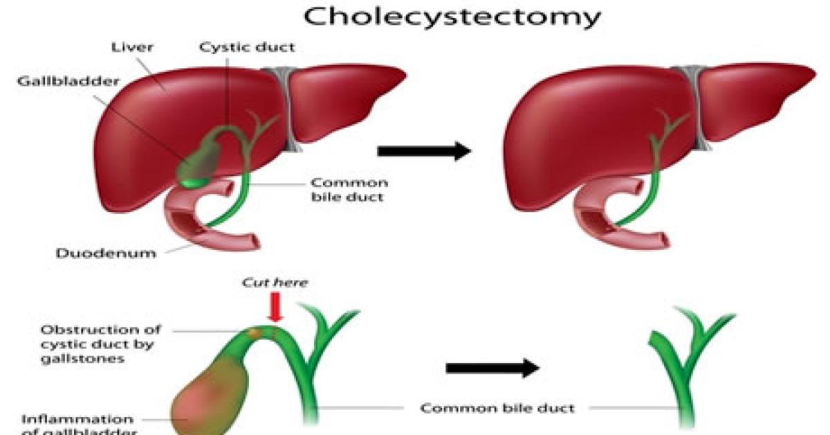 Cholécystectomie (ablation de la vésicule biliaire) : affections ...