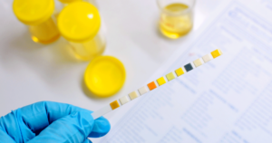 Urine foncée - Symptômes, causes, traitements