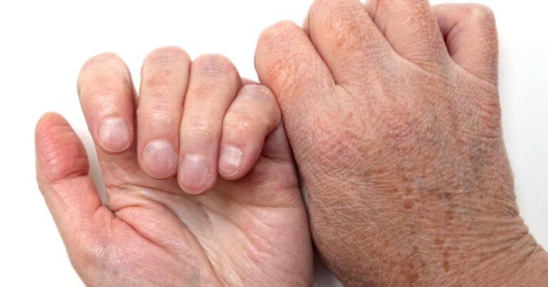 Peau squameuse - Symptômes, causes, traitements