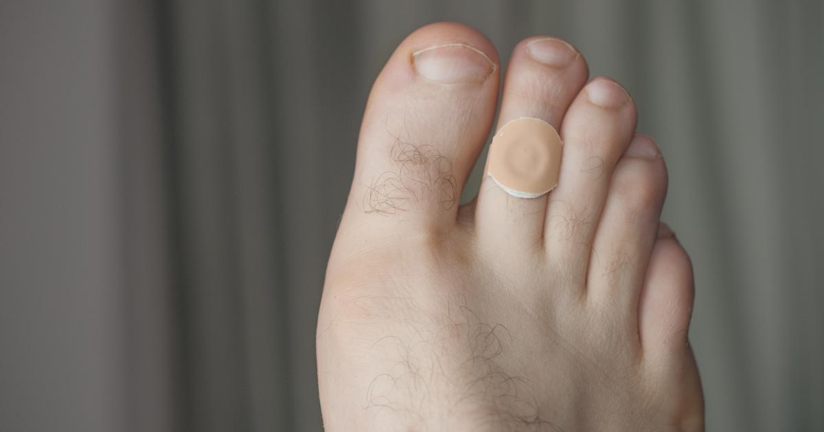 Comment traiter les cors ? Comment se débarrasser des cors et des ...