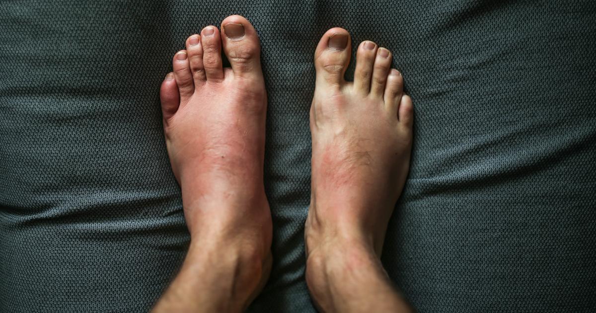 Éruption des jambes - Symptômes, causes, traitements