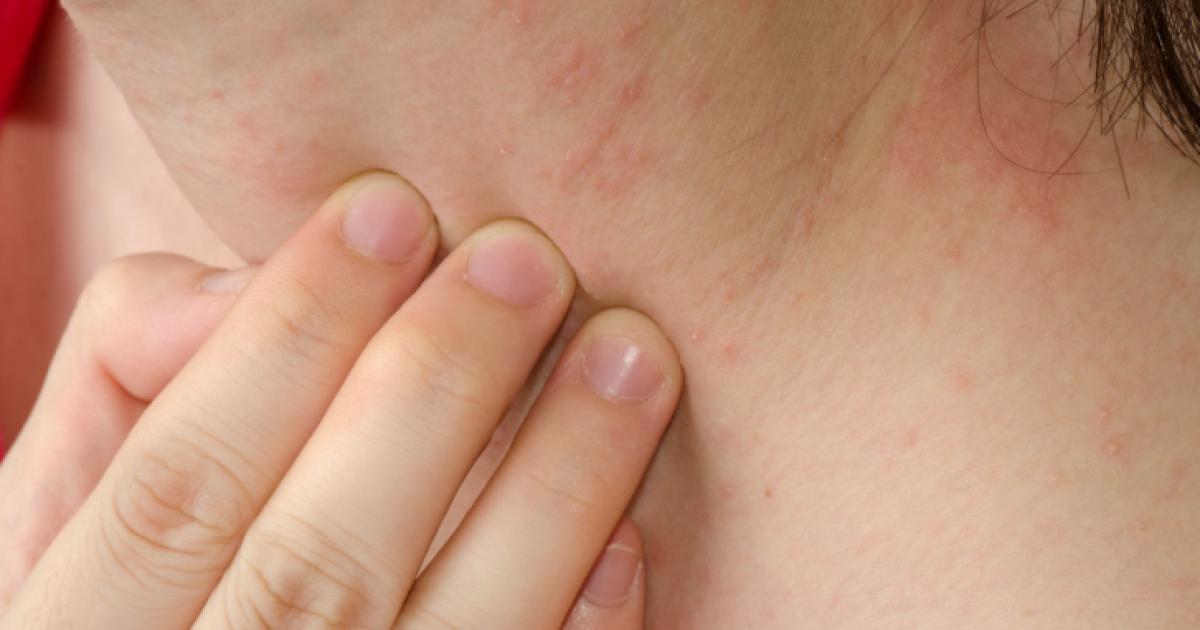 Taches rouges sur la peau - Symptômes, causes, traitements