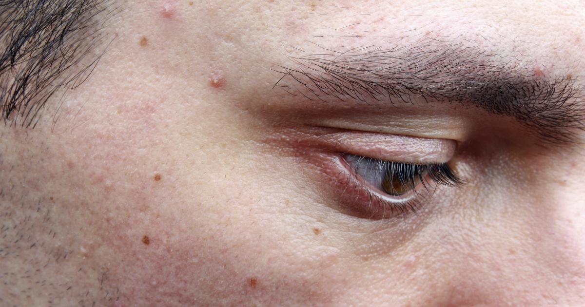 Que faire en cas de boutons qui ne disparaissent pas